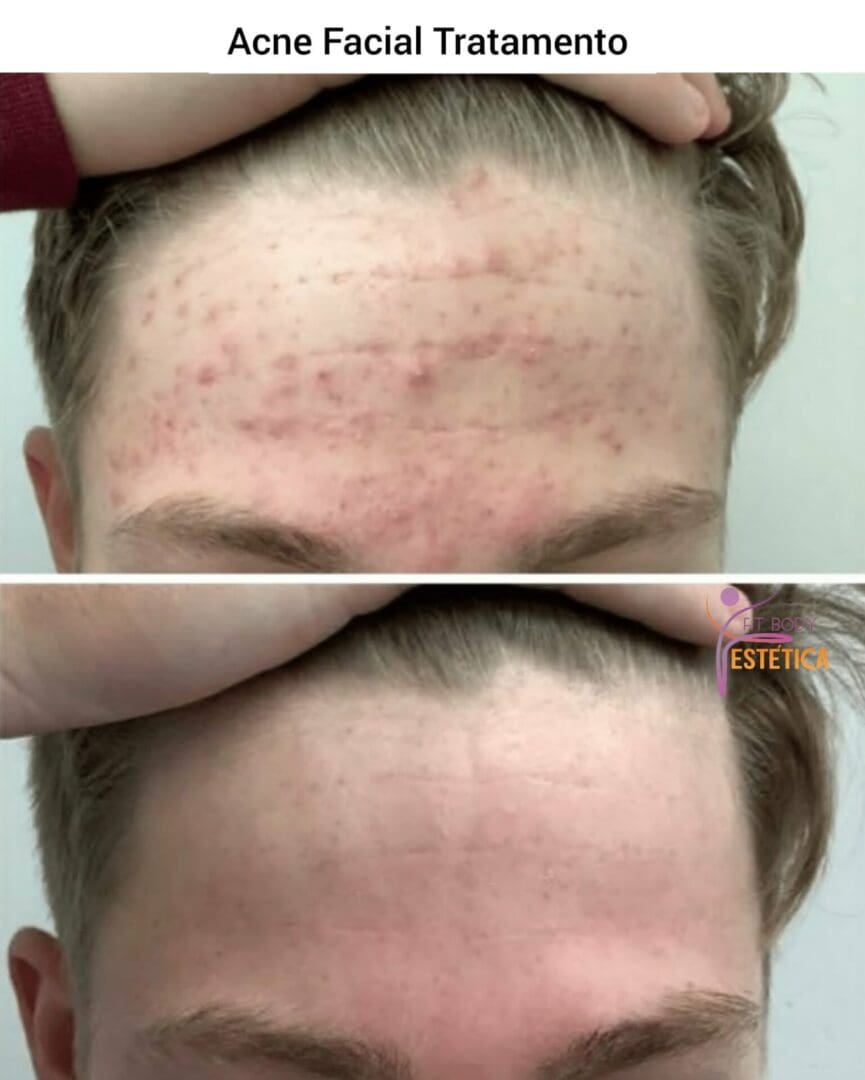 Acne Facial Tratamento - Clínica Fit Body Estética