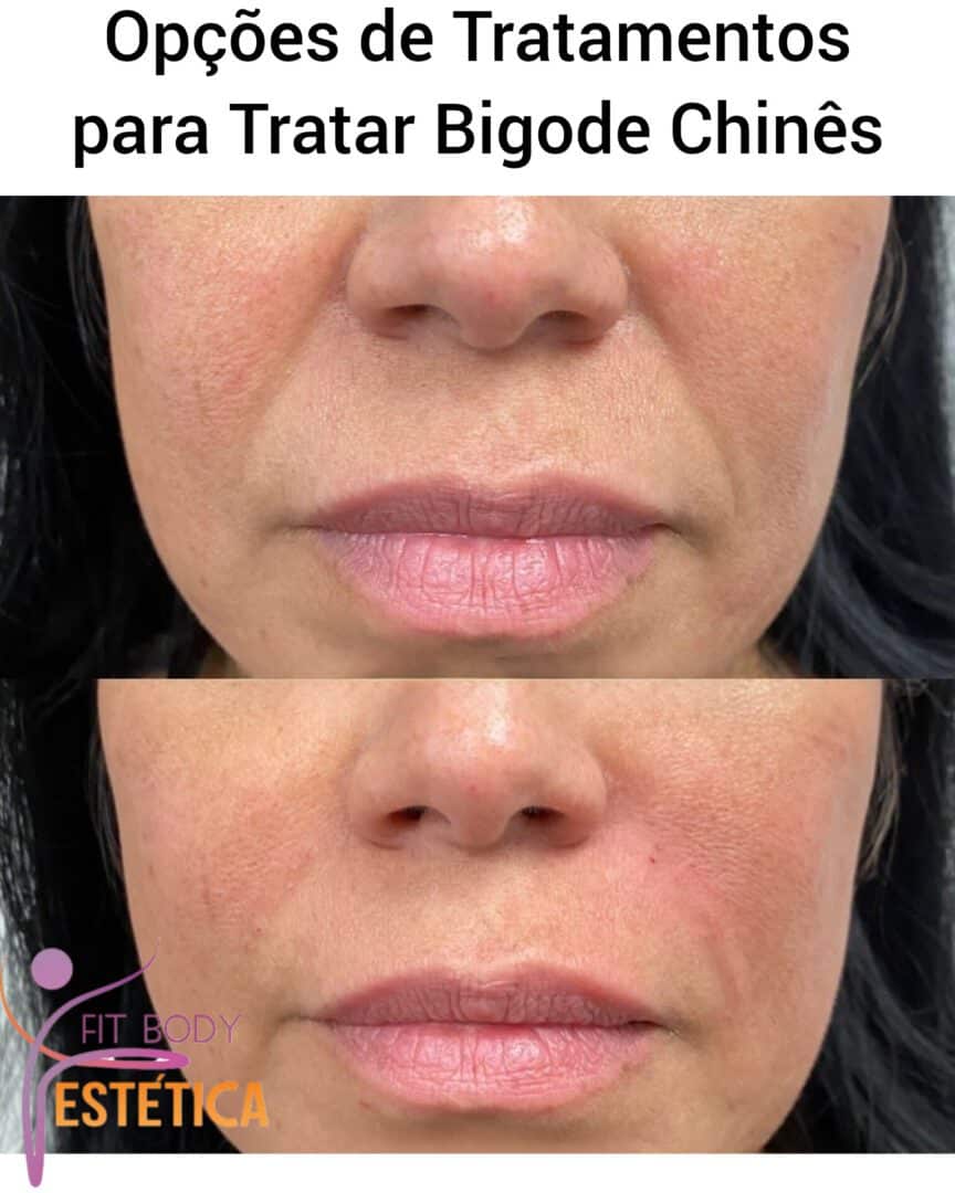 Opções de Tratamentos para Bigode Chinês - Dra.Sacha