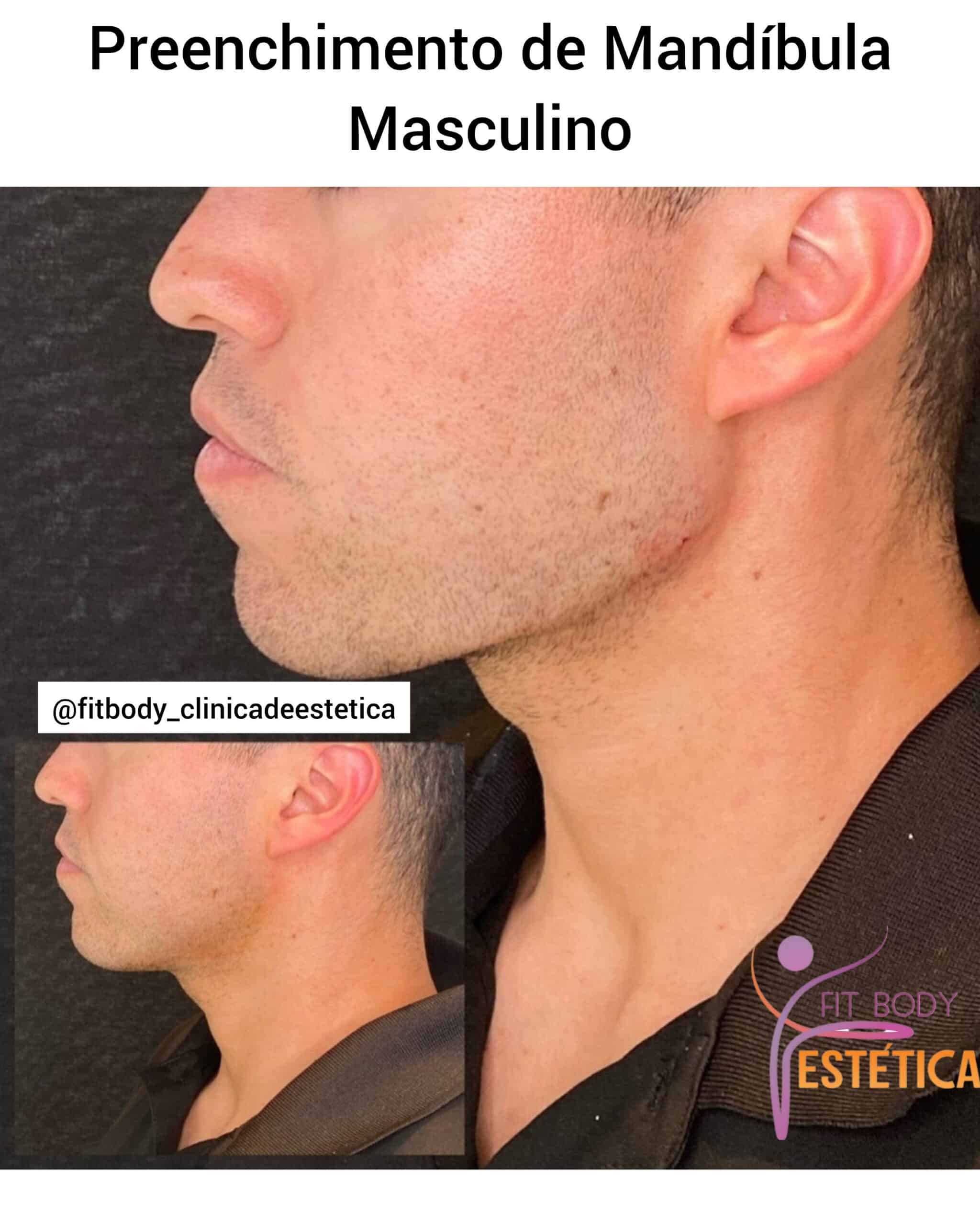 Preenchimento de Mandíbula Masculino - Clínica Fit Body Estética