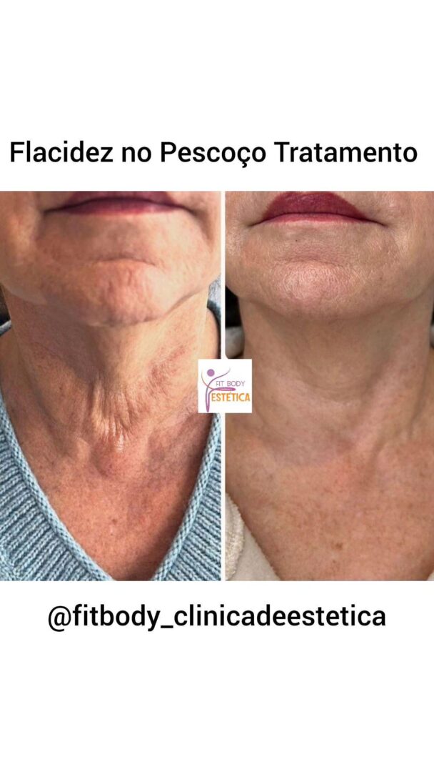 Flacidez no Pescoço - Clínica Fit Body Estética Flacidez no Pescoço - Clínica Fit Body Estética