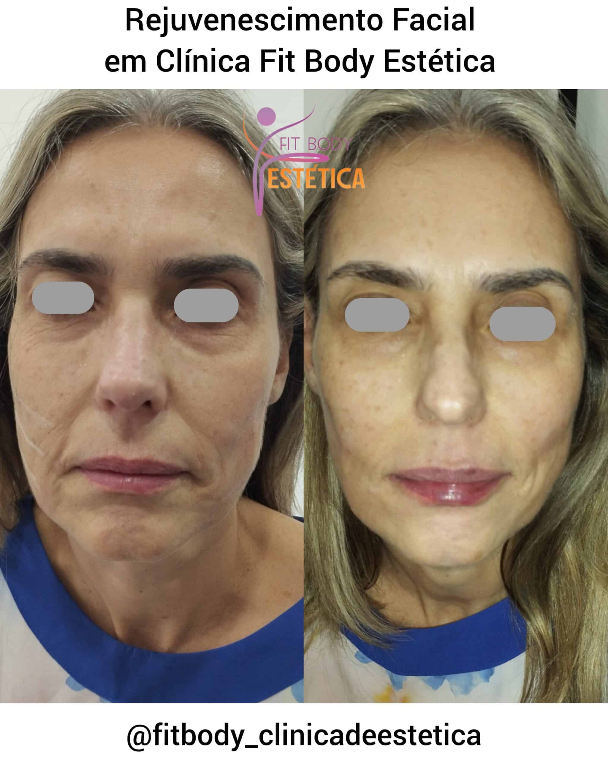 Rejuvenescimento Facial Clínica Fit Body - Dra.Sacha