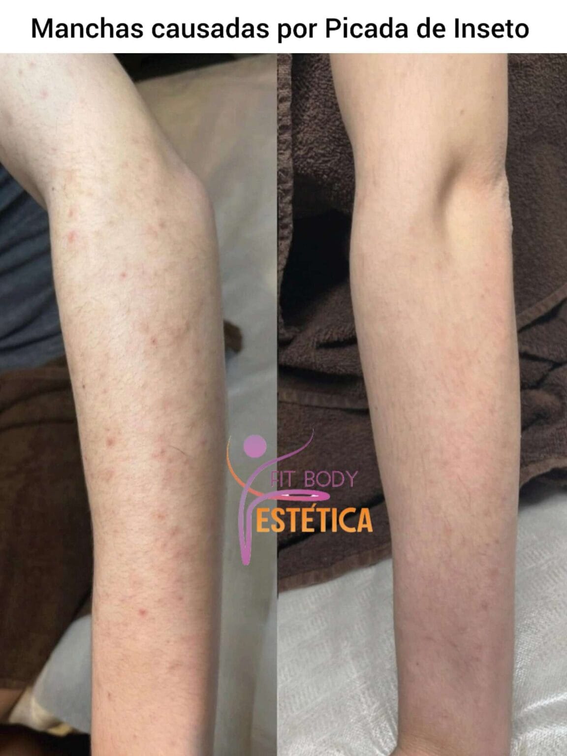 Manchas causadas por Picada de Insetos - Clínica Fit Body Estética