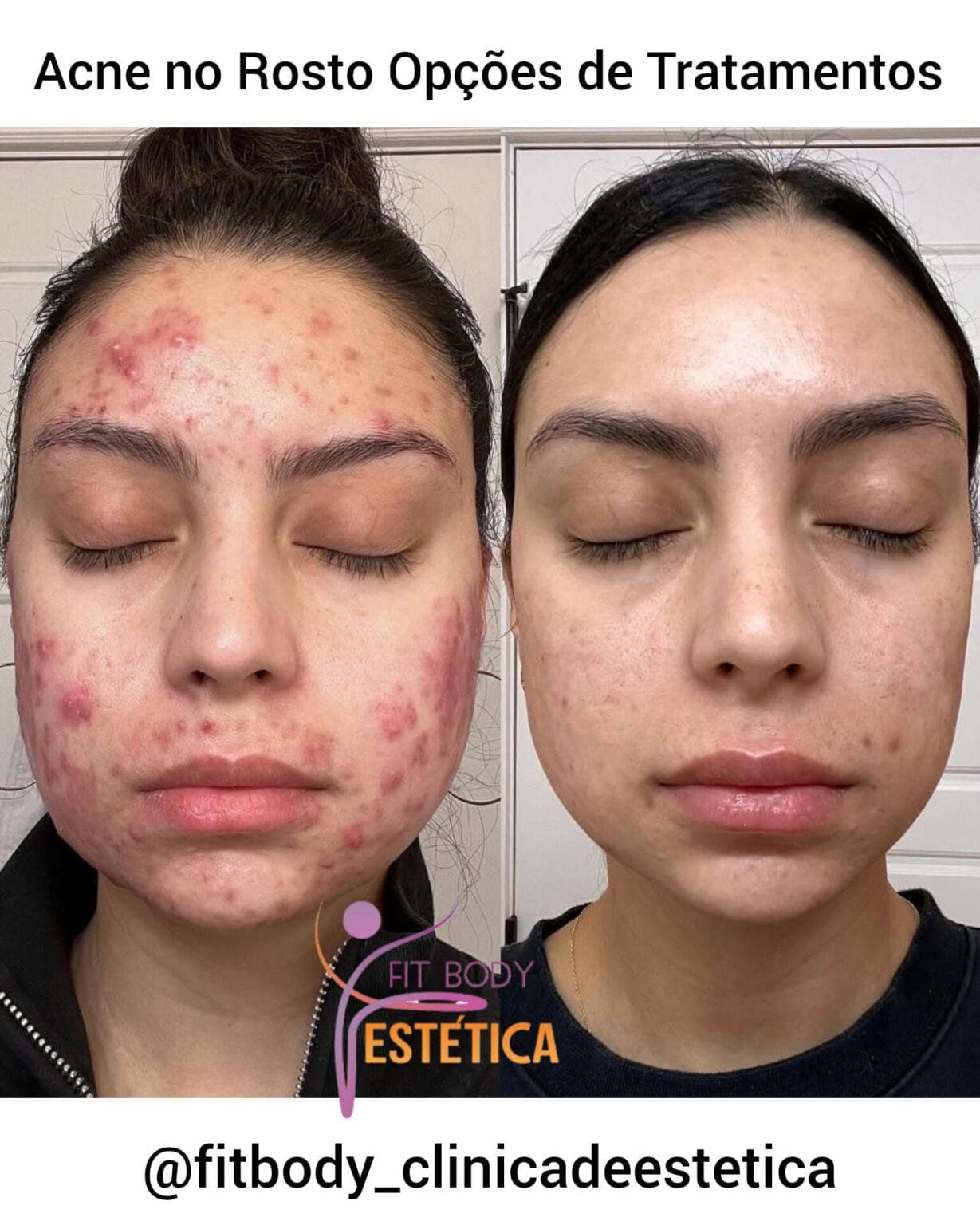 Acne no Rosto Opções de Tratamentos - Clínica Fit Body Estética