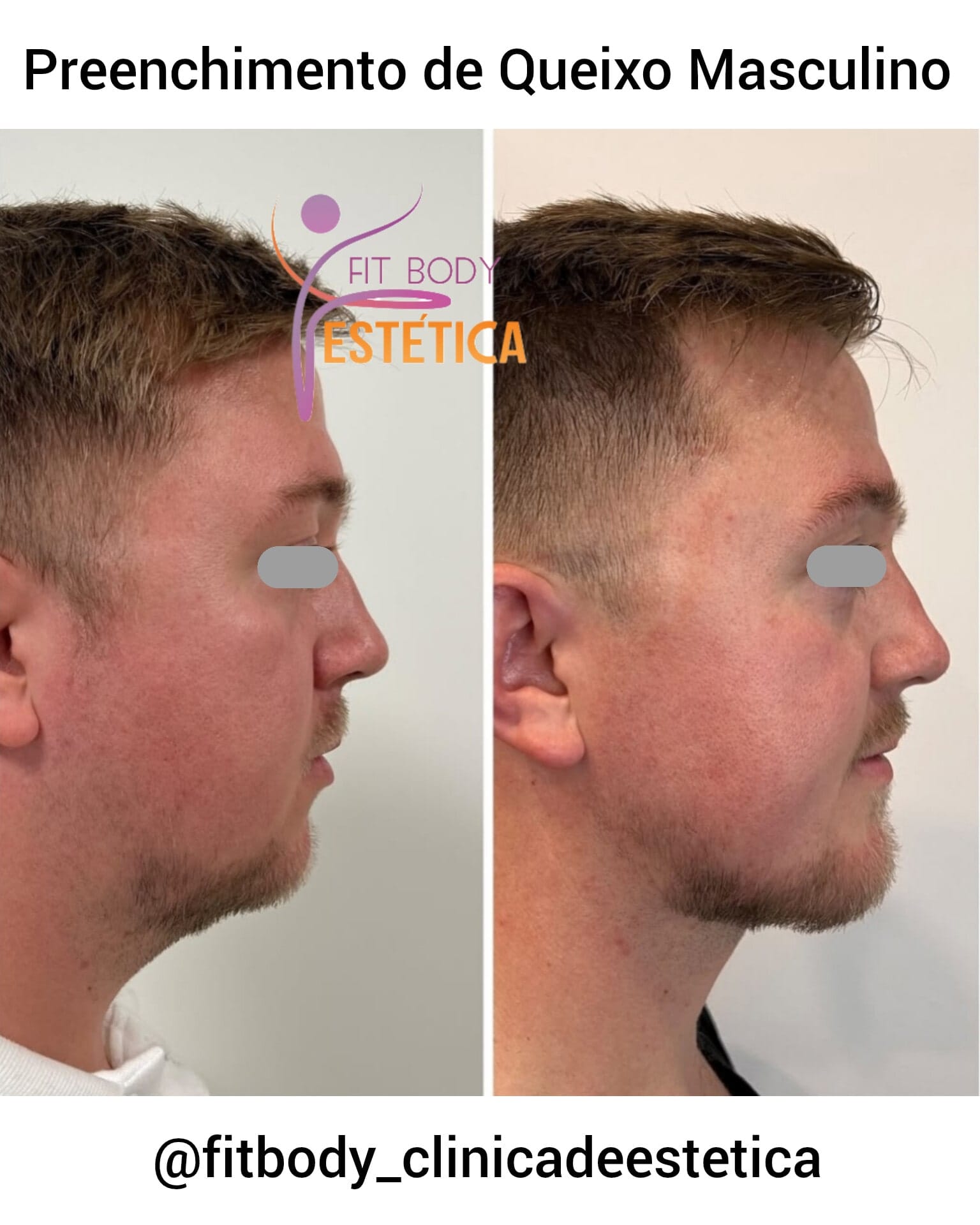 Preenchimento de Queixo Masculino - Dra.Sacha Silveira
